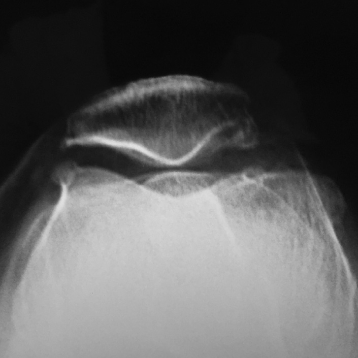 Luxación de patela | Dr. Ismael Alba